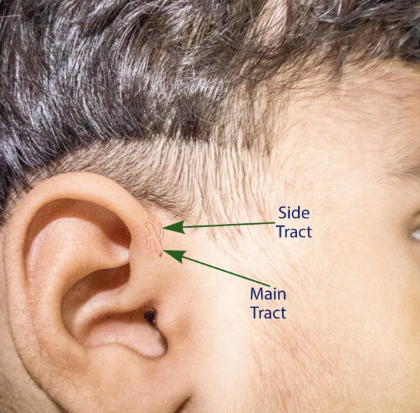 A hole near the ear! aka Preauricular Sinus – The Gentle Surgeon
